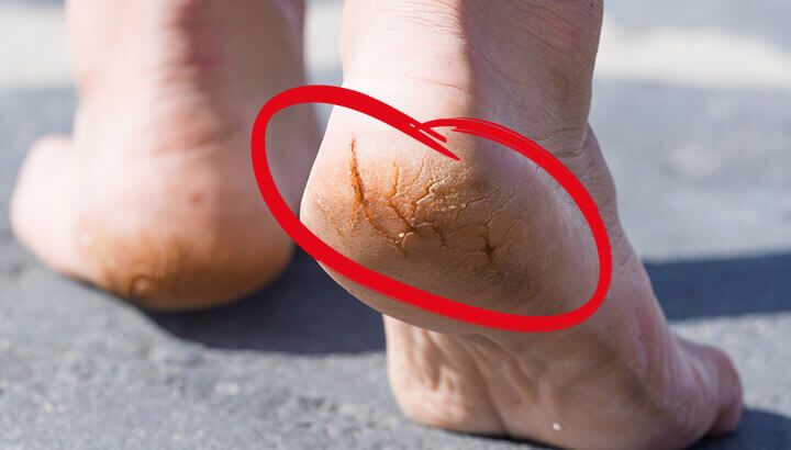 Say Goodbye To Cracked Heels For Good With This Soothing Remedy