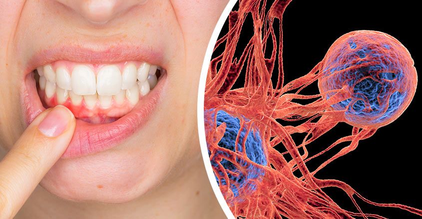 Got Gingivitis? Get Checked Out For This Deadly Gum Disease
