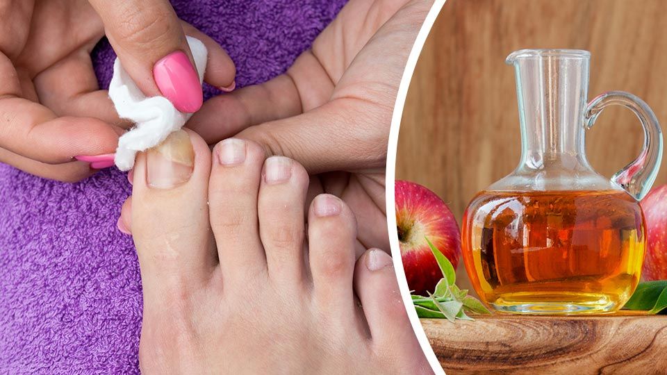 7 Natural Remedies To Get Rid of Toenail Fungus Forever ! (#3 Is A Must ...